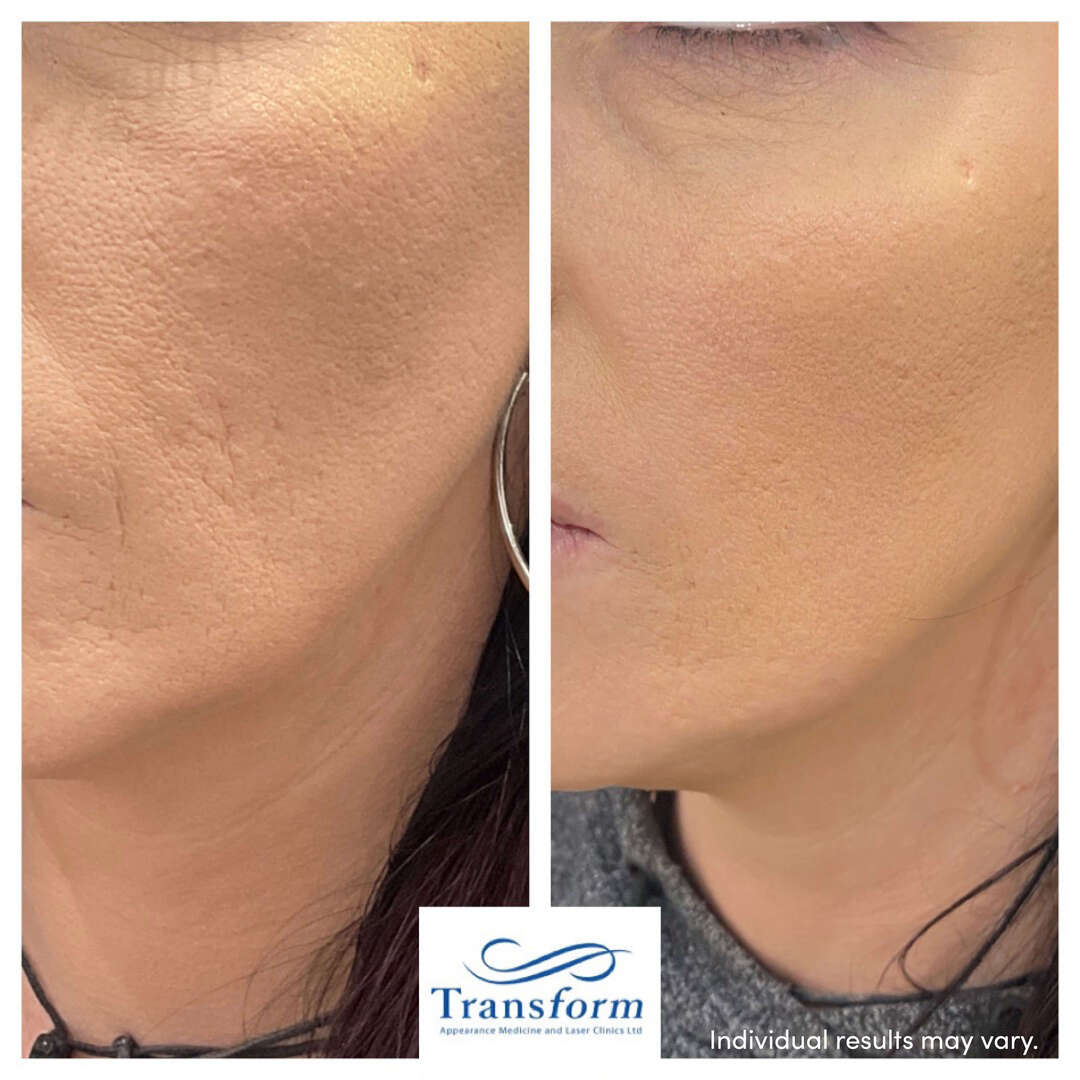 Your Guide to Profhilo®: Better than Botox & Fillers?