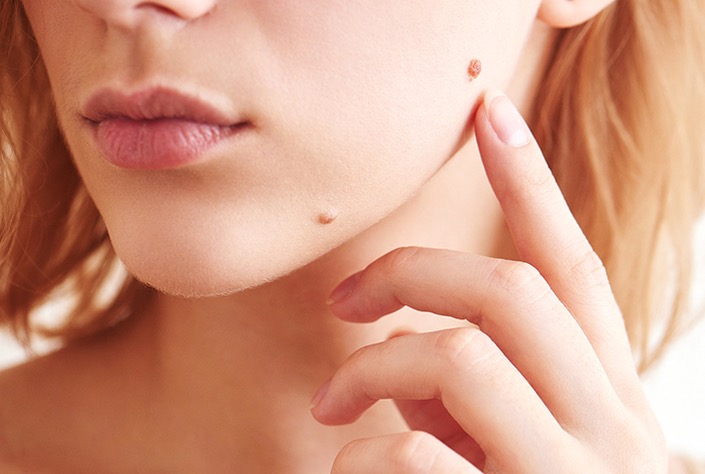 Skin Tag & Mole Removal - Transform Clinic Skin Tag & Mole Removal - Transform Clinic